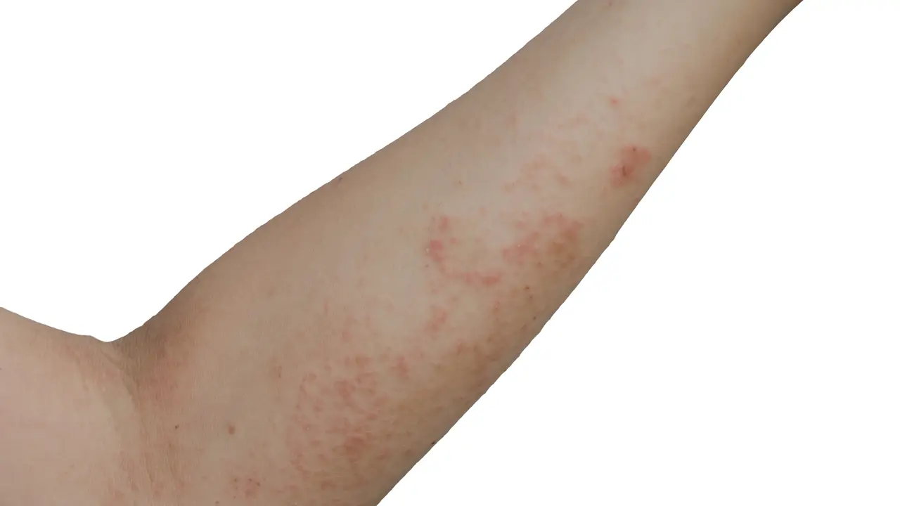 Penyebab Penyakit Dompo, Gejala, dan Cara Mengobatinya yang Perlu ...