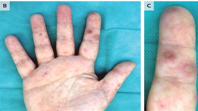 Wanita Terserang Demam dan Nyeri Otot Usai Digigit Tikus - Health ...