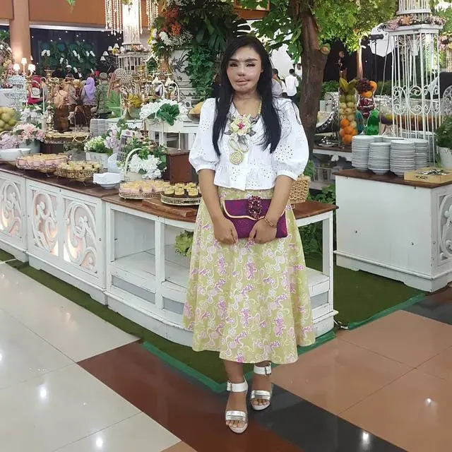 Kilas Balik Kisah Lisa, dari Korban Penyiraman Air Keras hingga Jadi ...