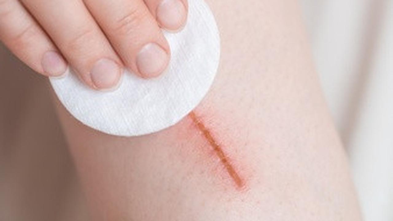 Luka Lecet Terlihat Ringan tapi Bisa Infeksi, Ini Cara Mengobatinya ...