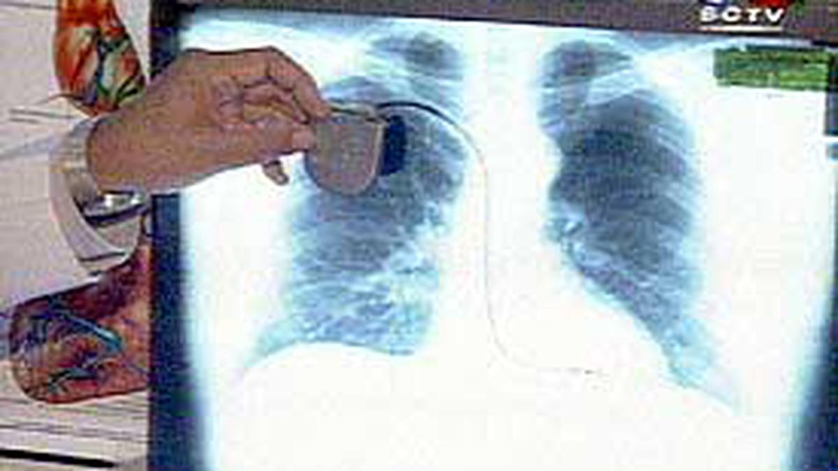 Jantung Berdenyut Normal Berkat Alat Pacu - News Liputan6.com