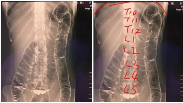 Viral Foto Rontgen Wanita Alami Sembelit Usus Sampai ke Jantung, Bikin ...