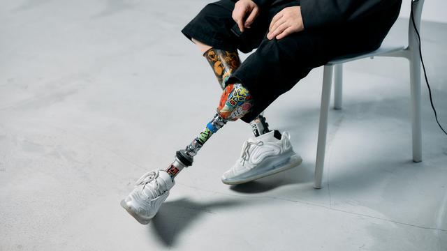 Berujung pada Amputasi dan Disabilitas, Ini Alasan Luka pada Pasien ...