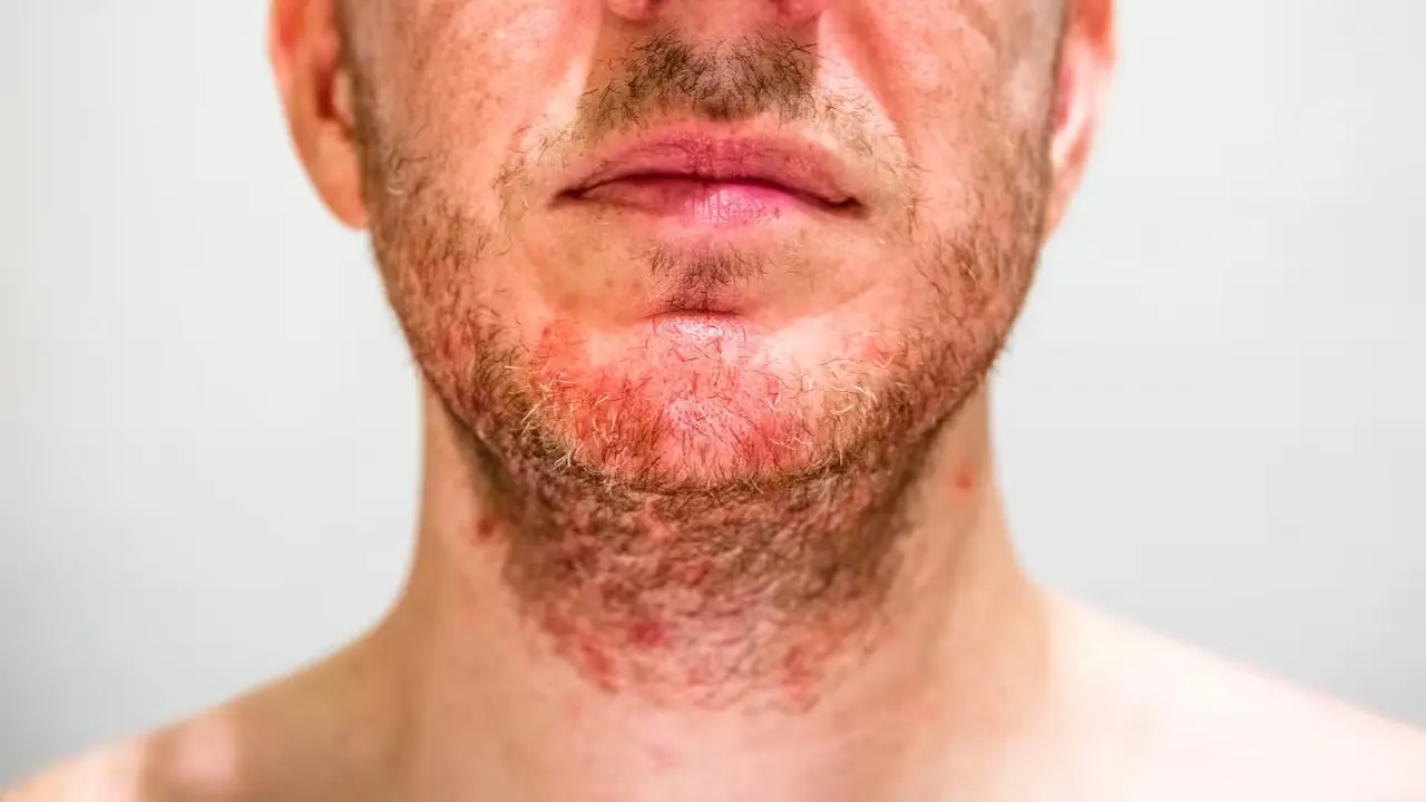 17 Jenis Gatal pada Kulit dan Gambarnya, Umum Diderita Semua Usia - Hot ...