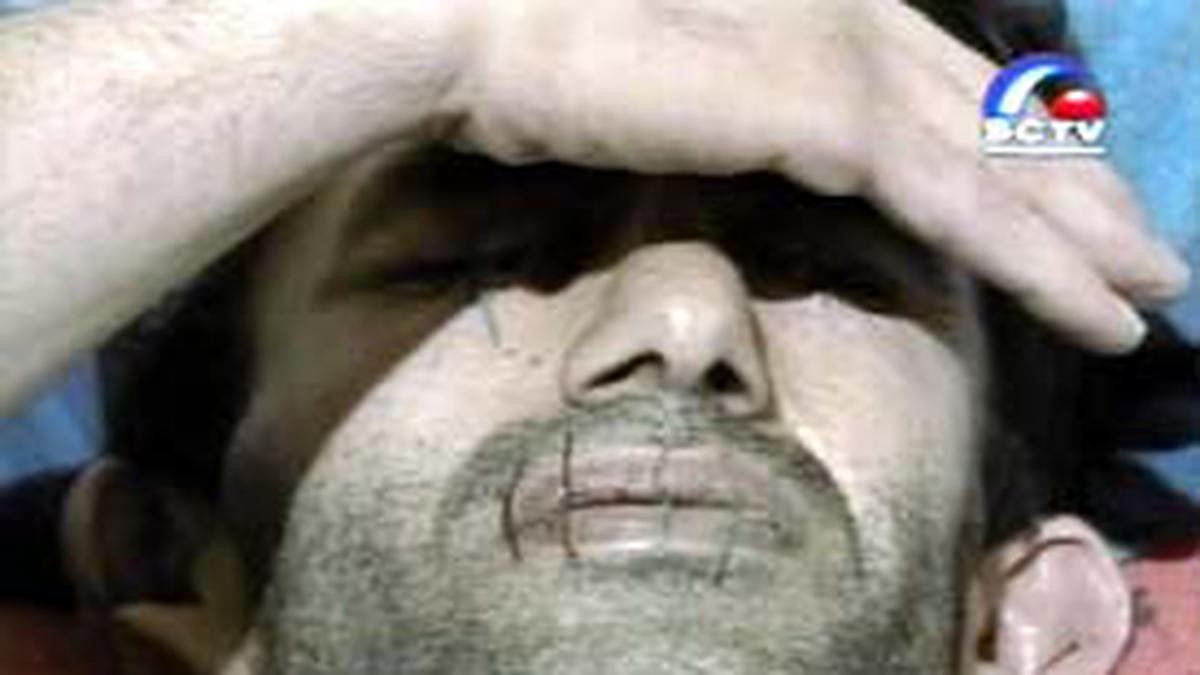 Bila Kelopak Mata Dijahit Sebagai Bentuk Protes - Global Liputan6.com