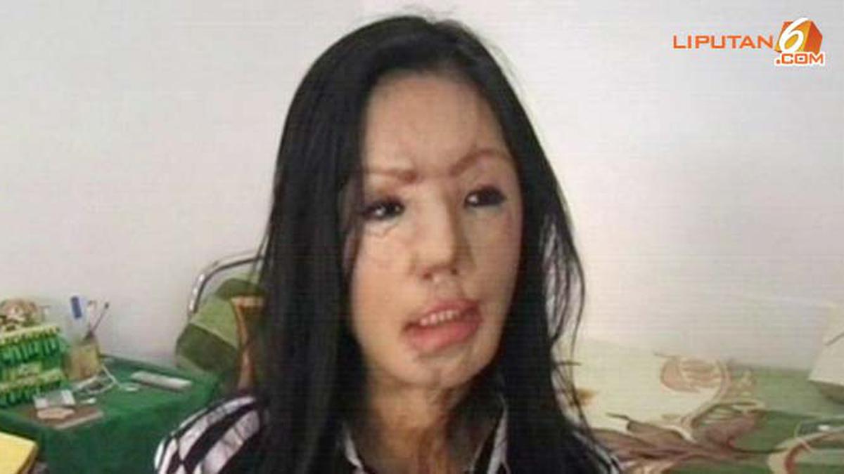 [VIDEO] Lisa `Pasien Face Off` Kembali ke Tengah Masyarakat - News ...