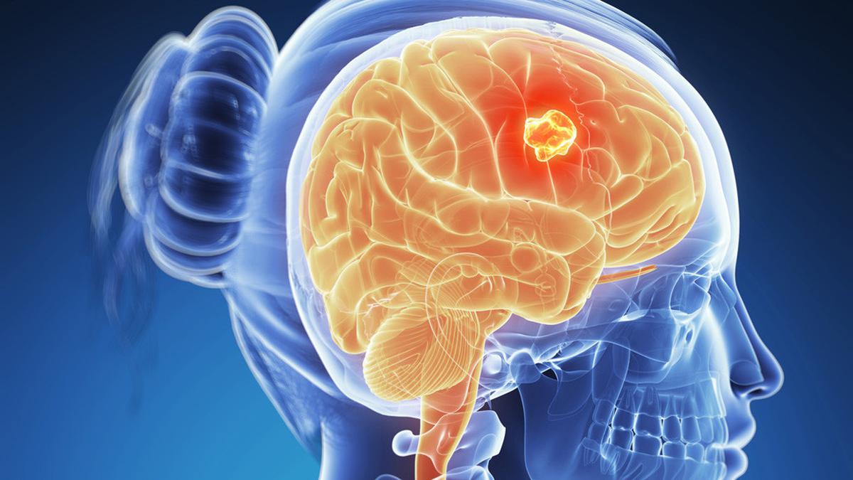 Gejala Kanker Otak, Penyebab, dan Pencegahannya yang Perlu Dilakukan