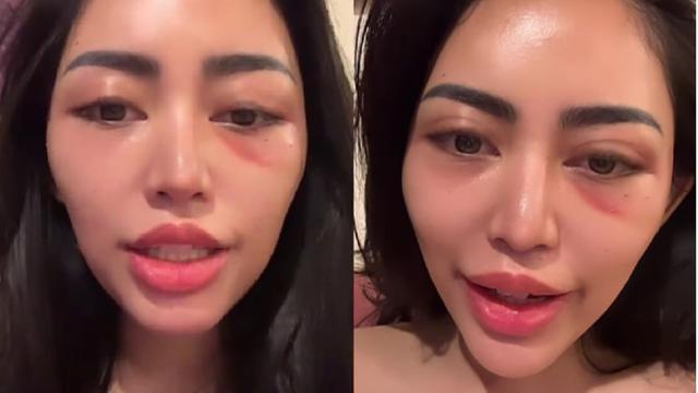7 Potret Rachel Vennya Oplas Sedot Lemak Pipi, Hasilnya Makin Tirus Tapi Mata Bengkak