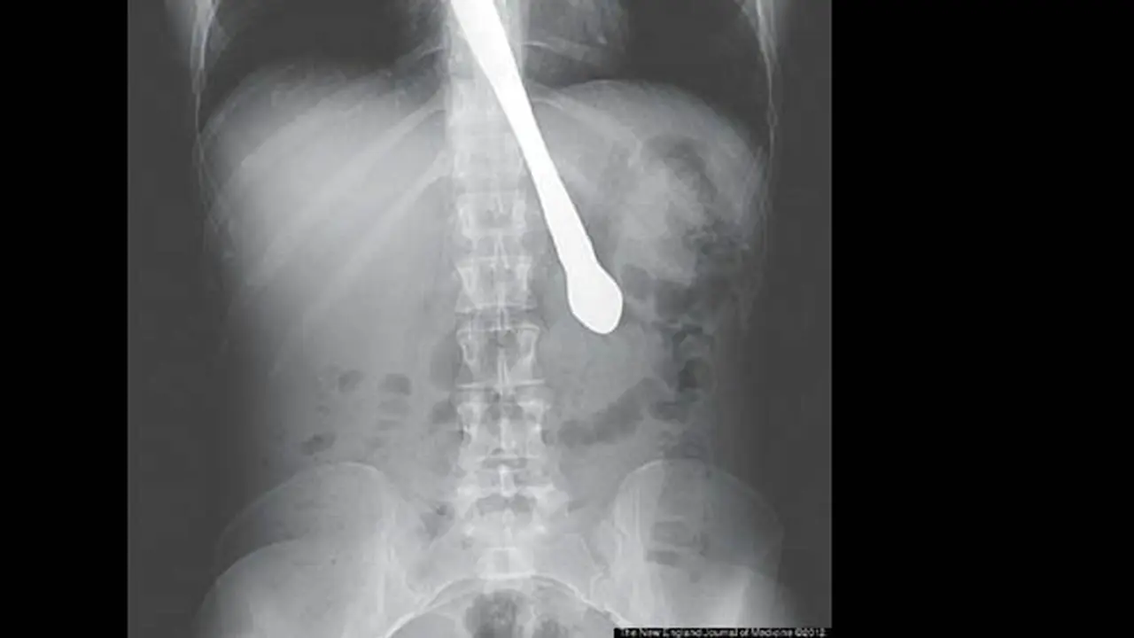 10 Foto Rontgen Dengan Benda 'Aneh' Dalam Tubuh