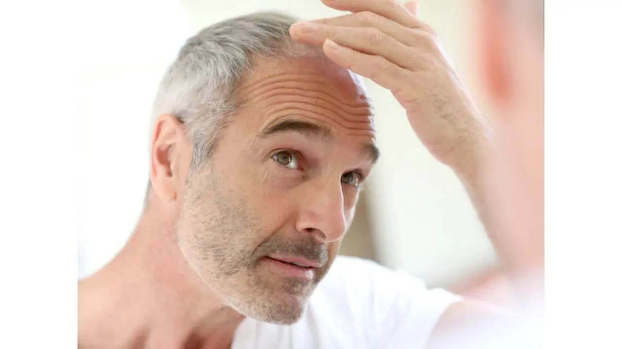 5 Fakta Menarik Mengenai Kebotakan - Fashion & Beauty Liputan6.com