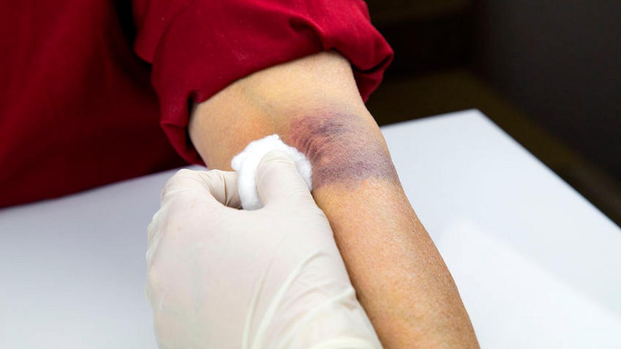 5 Cara Menghilangkan Memar di Tubuh Secara Alami, Mudah dan Ampuh