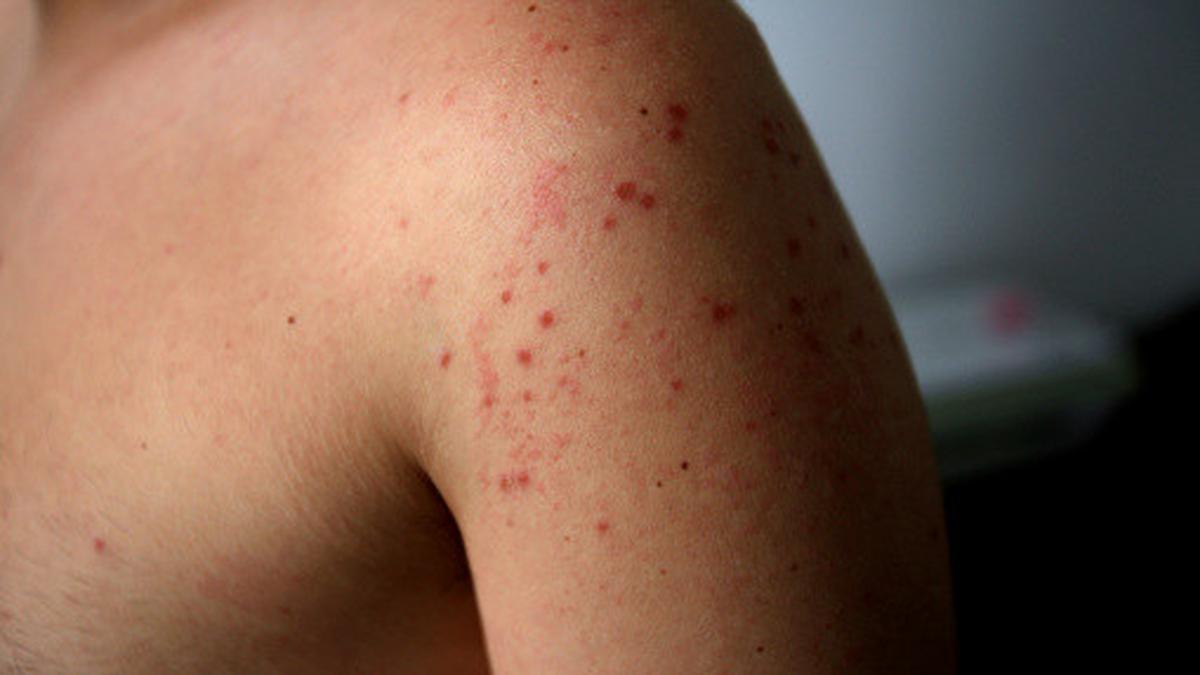 Waspada Campak Kasus Suspek Meningkat Sebanyak 32 Kali Lipat Health