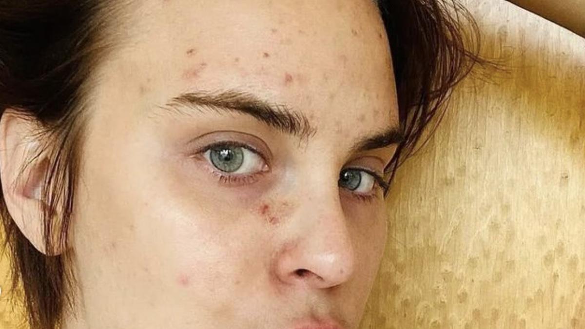 Talullah Willis, Anak Demi Moore Ungkap Masalah Kulit Unik yang Dialaminya