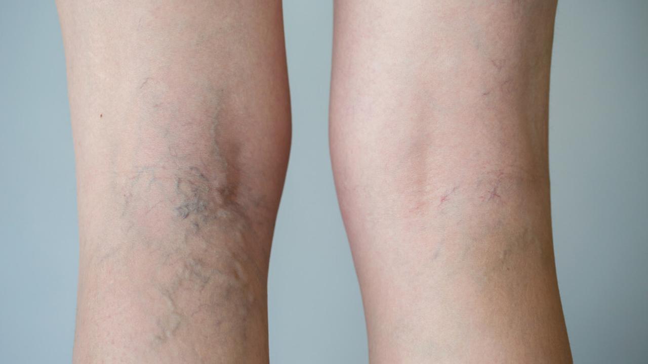 Varises dan Diabetes Bisa Bikin Luka Kaki, Ketahui Penyebab dan ...