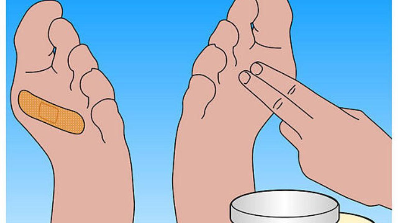 Cara Mengobati Kutu Air di Kaki yang Membandel, Dijamin Ampuh dan Cepat ...