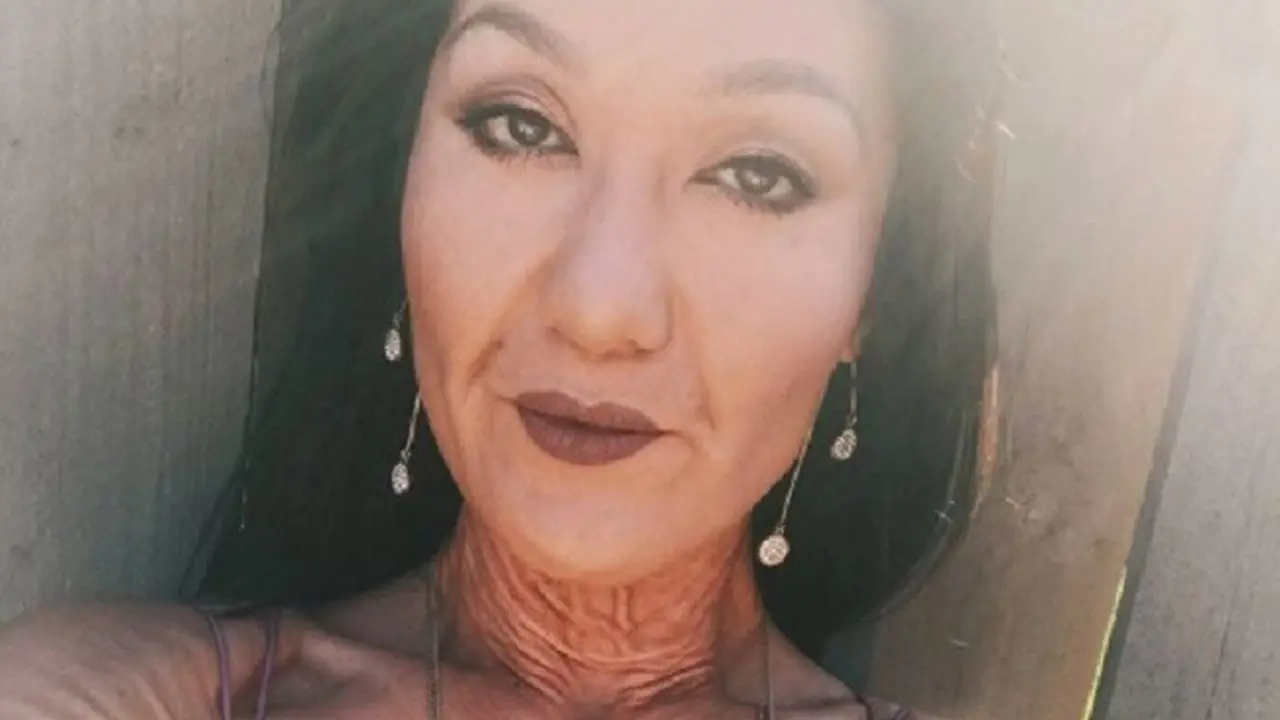 Sara Geurts, Model yang Menderita Kulit Kendur - Lifestyle Liputan6.com