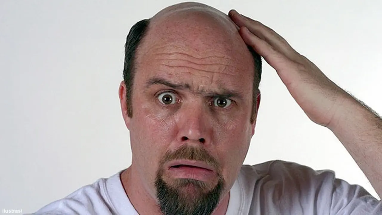 Kenapa Pria Cenderung Botak? - Health Liputan6.com