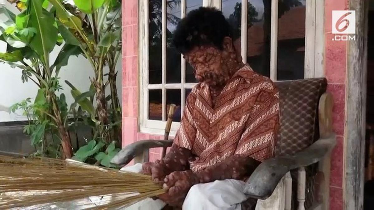 VIDEO: Parni Manusia Kutil Asal Jember - Regional Liputan6.com