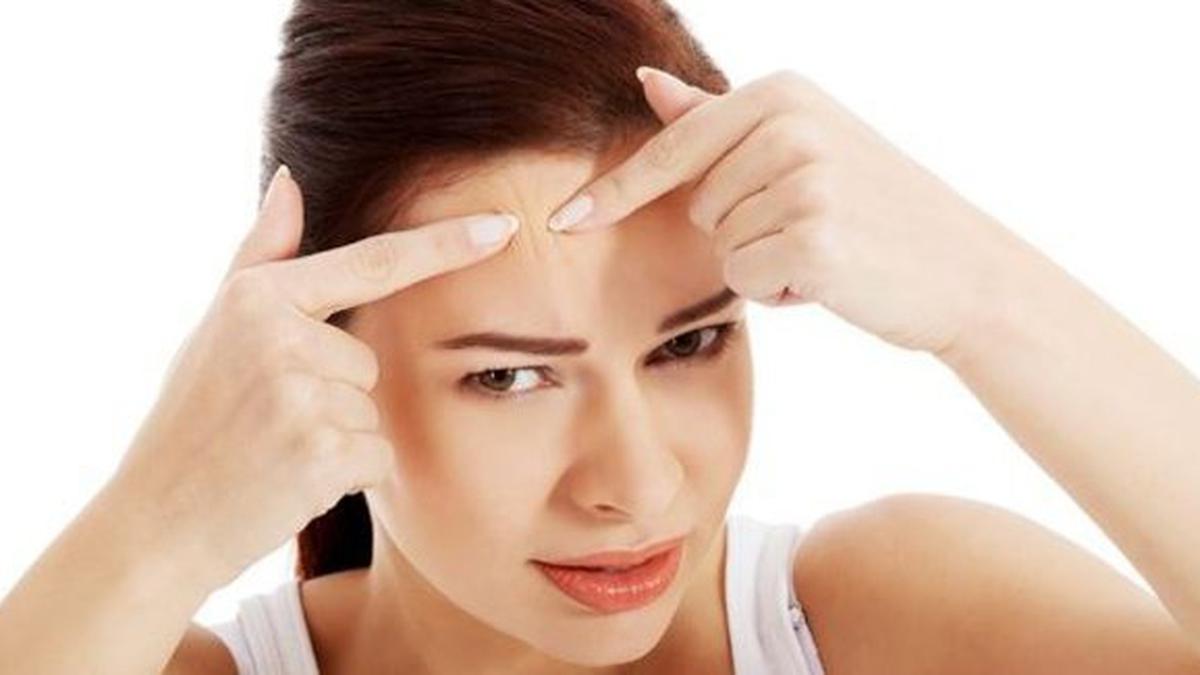 Tips Aman Atasi Jerawat Bagi Ibu Hamil, Penting Mom!