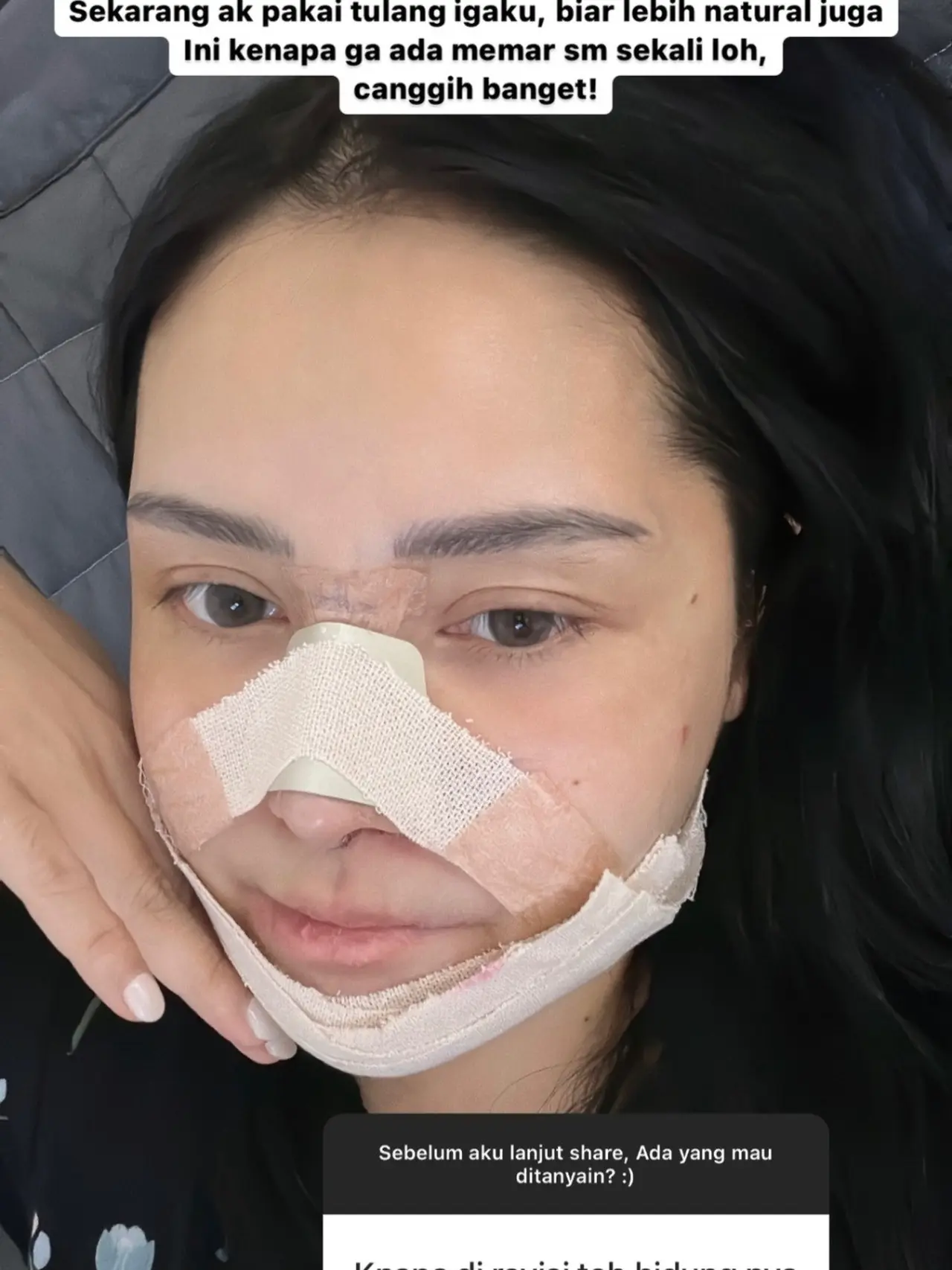 6 Potret Mawar AFI Oplas Hidung Kedua di Korea, Implan Pakai Tulang Iga ...