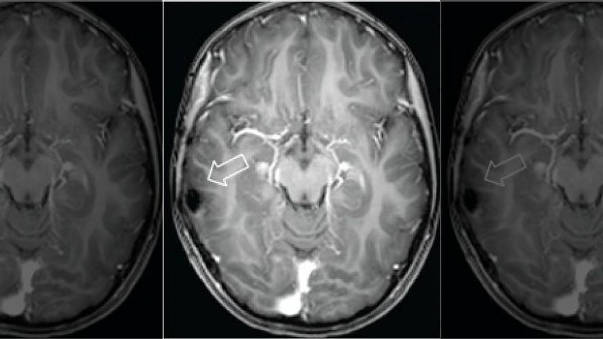 Intip Operasi Tumor Otak Melalui Alis Mata