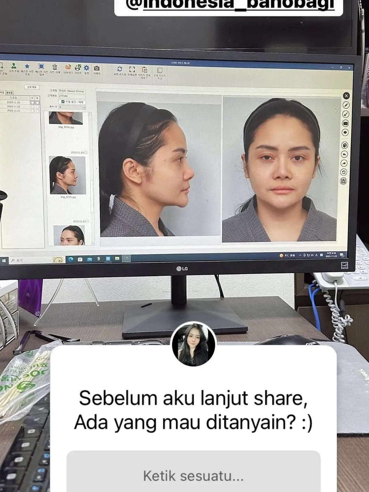 6 Potret Mawar AFI Oplas Hidung Kedua di Korea, Implan Pakai Tulang Iga ...