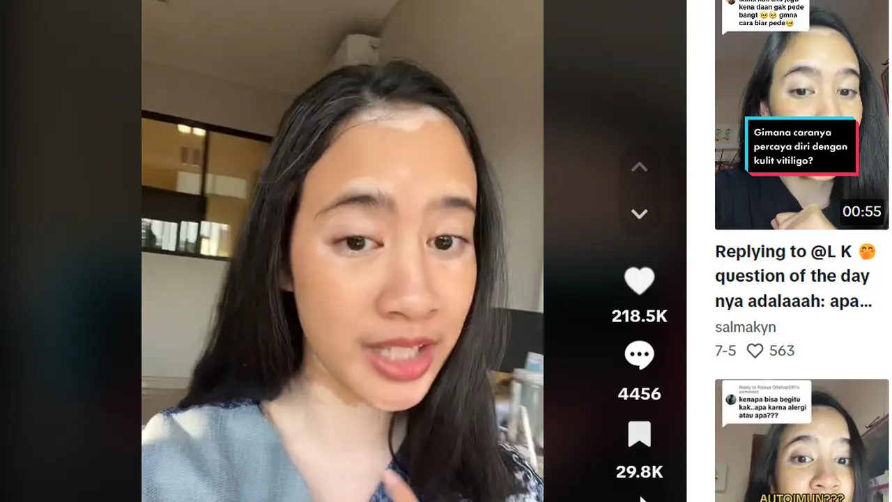 Cerita Dokter Kena Vitiligo, Berawal dari Konsumsi Suplemen Herbal yang Beli di Agen MLM ...