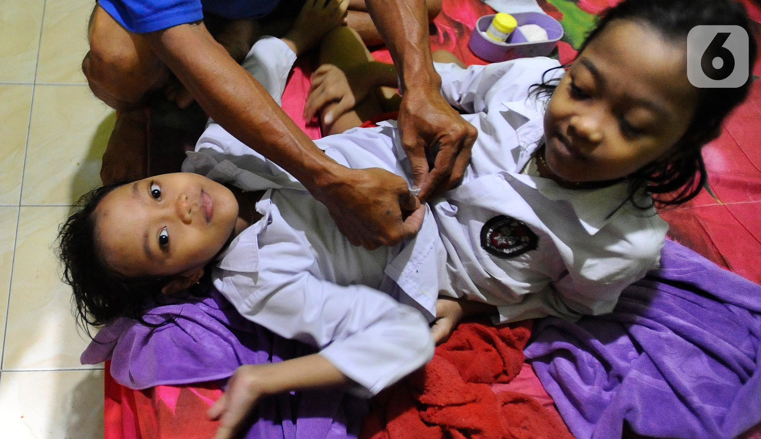 Potret Semangat Kembar Siam Al Dewi dan Al Putri Asal Garut