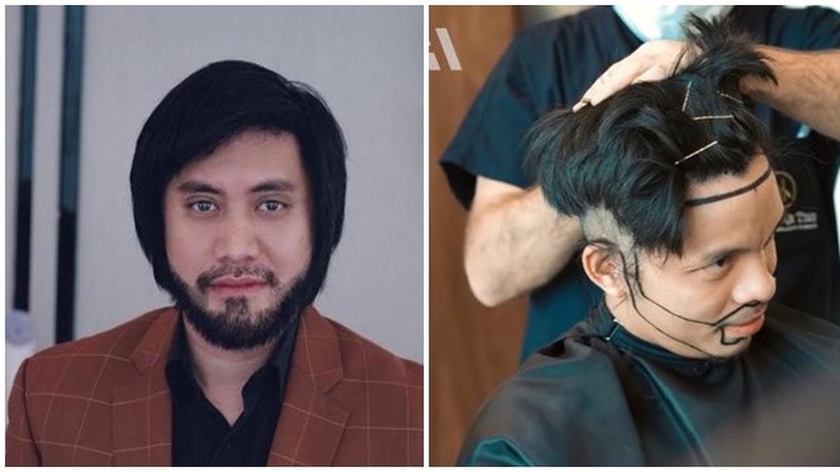 6 Artis yang Pernah Transplantasi Rambut, Terbaru Atta Halilintar - Hot ...