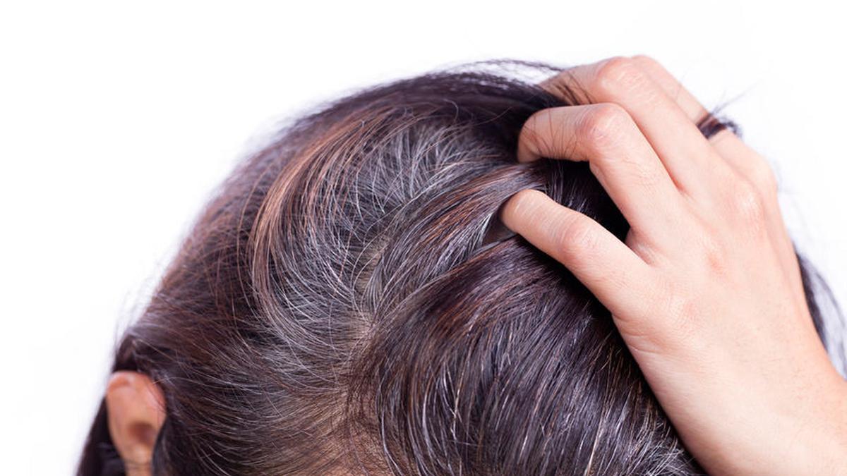 Top 3 Hari Ini: Penyebab Tak Terduga Datangnya Uban di Usia Muda