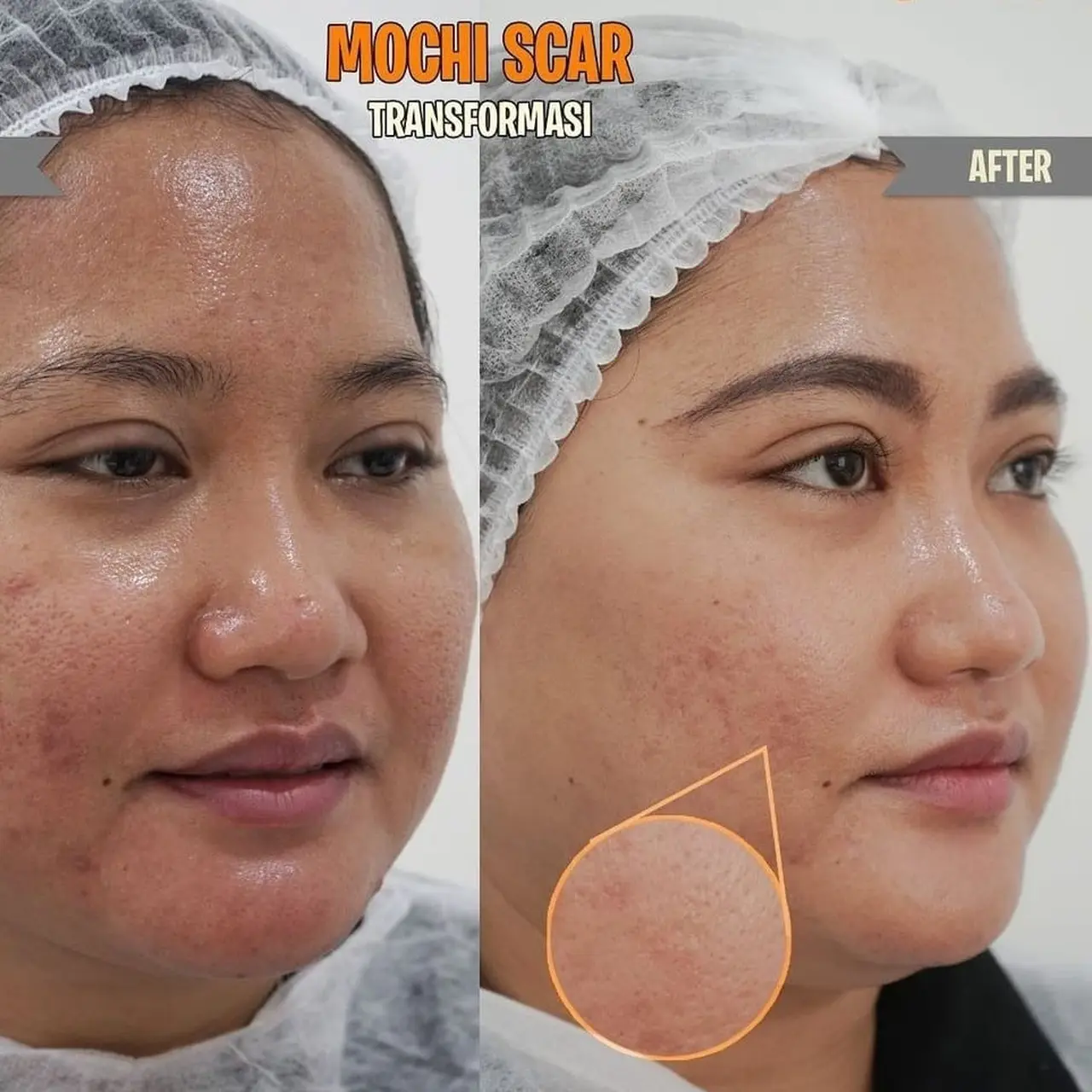 Tren Mochi Scar Jadi Solusi Menghaluskan dan Meregenerasi Kulit ...