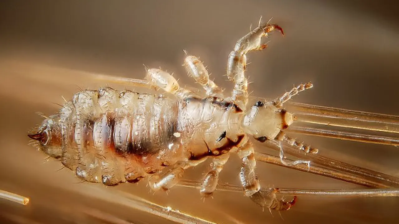 7 Penyebab Kutu Rambut yang Wajib Diketahui, Lengkap Cara ...