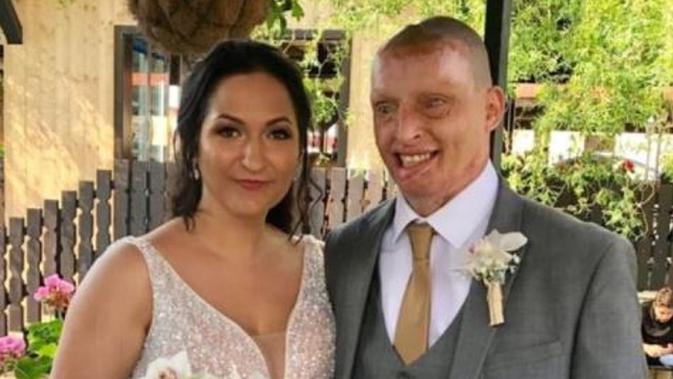 Curahan Hati Lelaki yang Pernah Disiram Air Keras oleh Mantan Kekasih ...