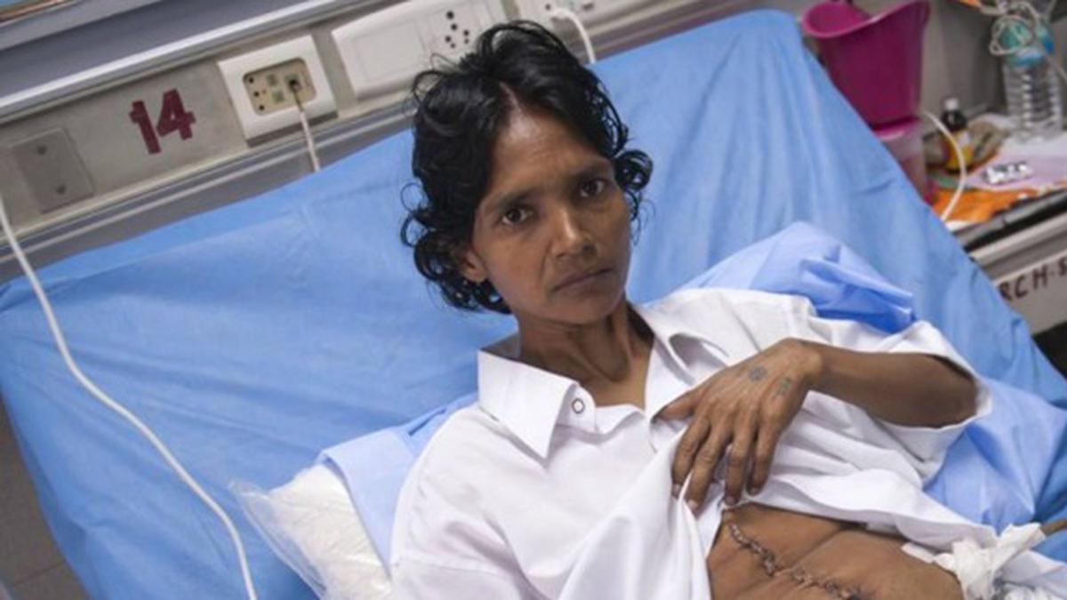 Operasi Pengangkatan Tumor Fenomenal, Tumor Seberat 17 Kg Berhasil Diangkat