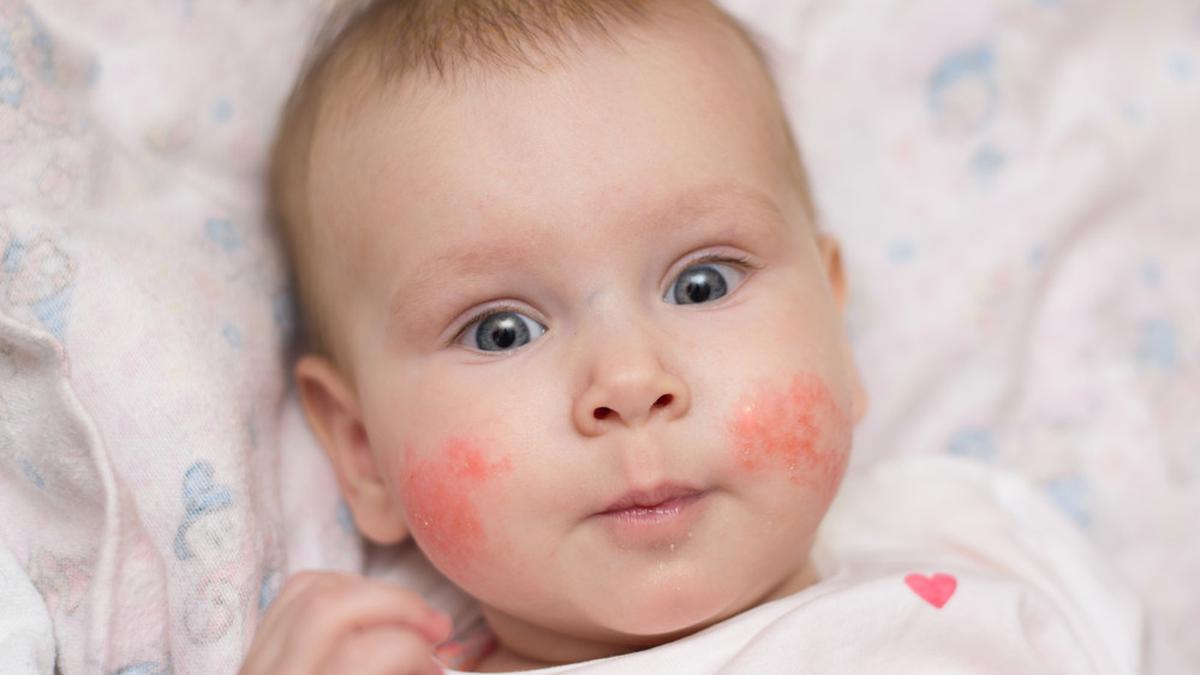 Amankah Anak dengan Dermatitis Atopik Mandi Air Hangat?