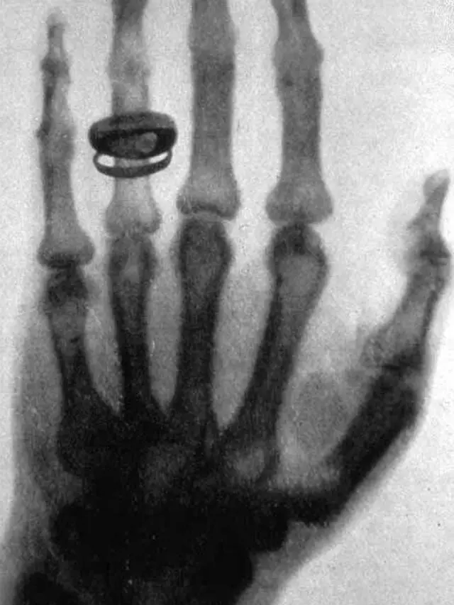 8 November 1895: Wilhelm Roentgen Menemukan X-Ray - Global Liputan6.com