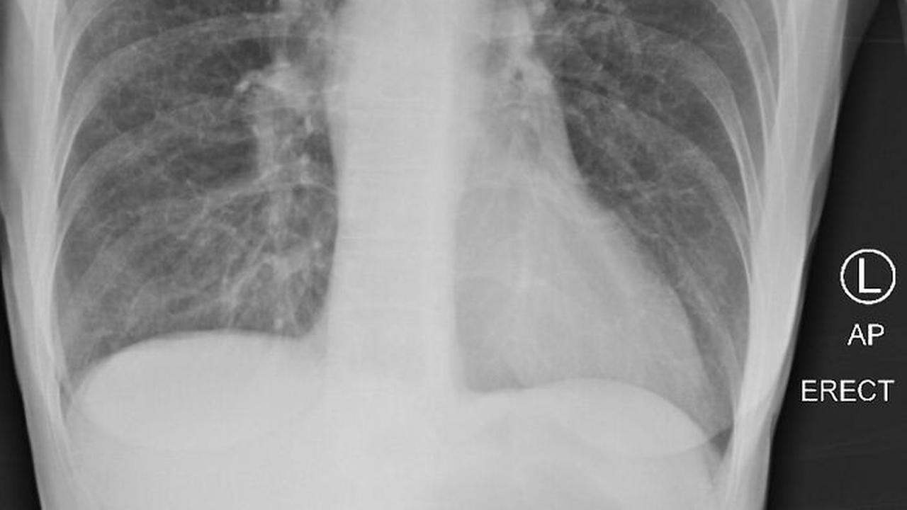 7 Cara Membersihkan Paru-Paru Akibat Rokok, Cepat dan Efektif