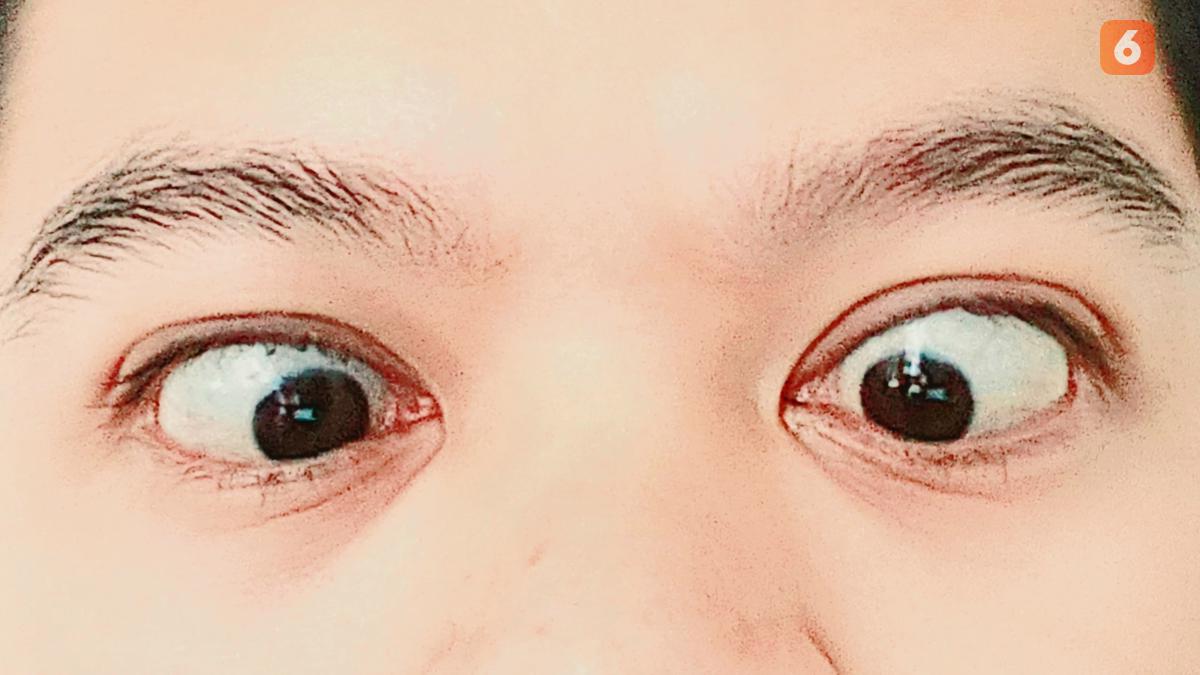 Mata Juling Bukan Sekadar Masalah Estetika, Bisa Pengaruhi Kemampuan ...